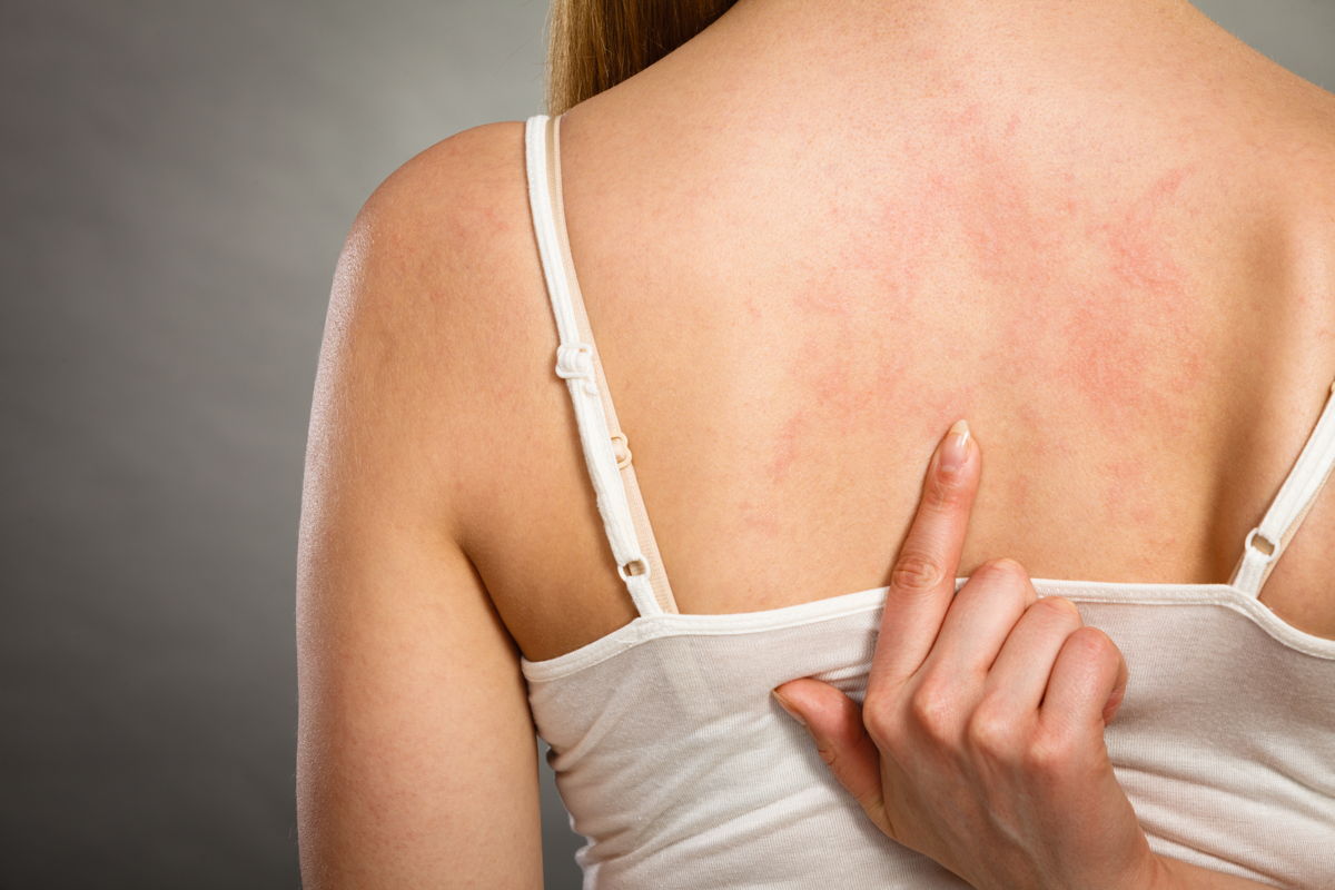 Le Cause Dell orticaria E Come Si Tratta SB Medical Le Cause Dell orticaria E Come Si Tratta SB Medical